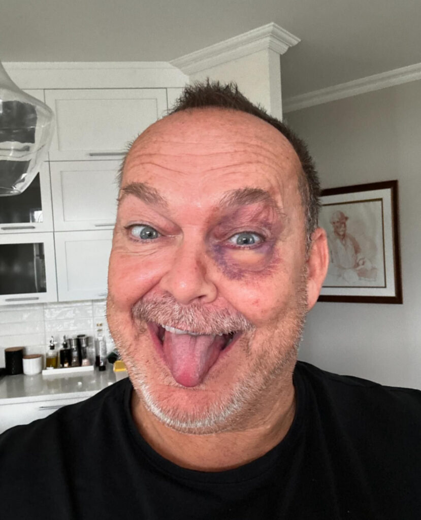 Jean-Michel Anctil sort et dévoile la raison de son oeil au beurre noir ...